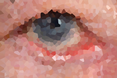 Ectropion - College of Optometrists