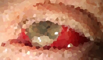 Endophthalmitis (post-operative) (exogenous endophthalmitis) - College ...