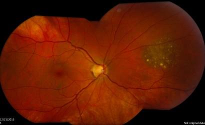 Pigmented fundus lesions - College of Optometrists
