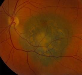 Pigmented fundus lesions - College of Optometrists