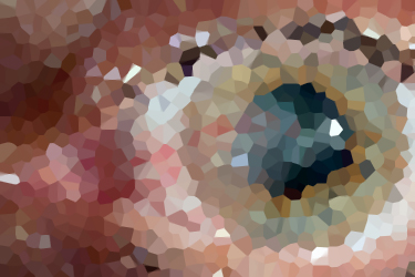 Pterygium - College of Optometrists