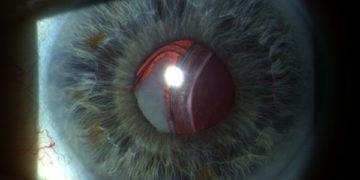 Posterior chamber dislocation of the intraocular lens - College of ...