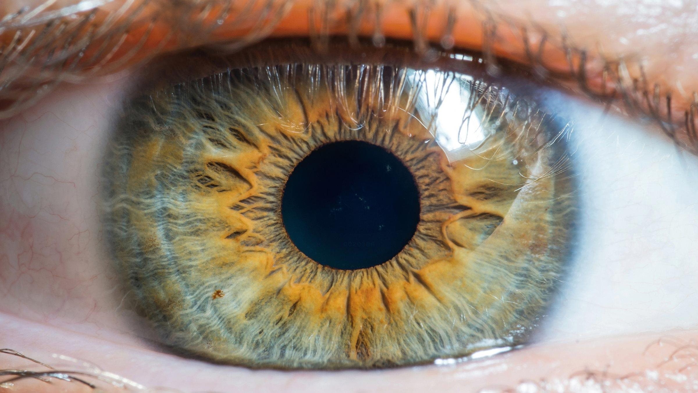 NICE Guideline - Cataracts in adults: management - College of Optometrists