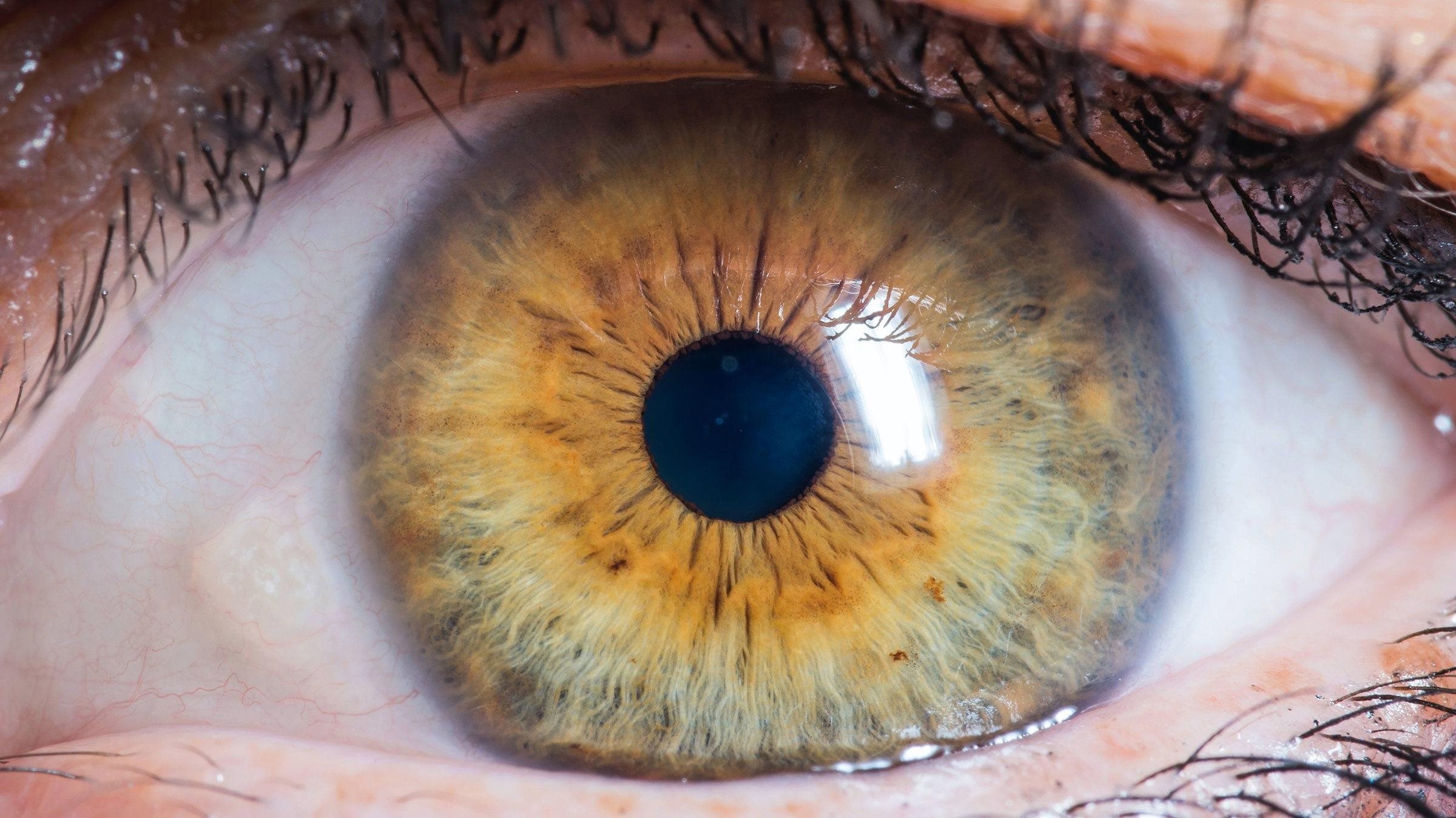 WebinarXtra: OCT in optometric practice for beginners - College of ...